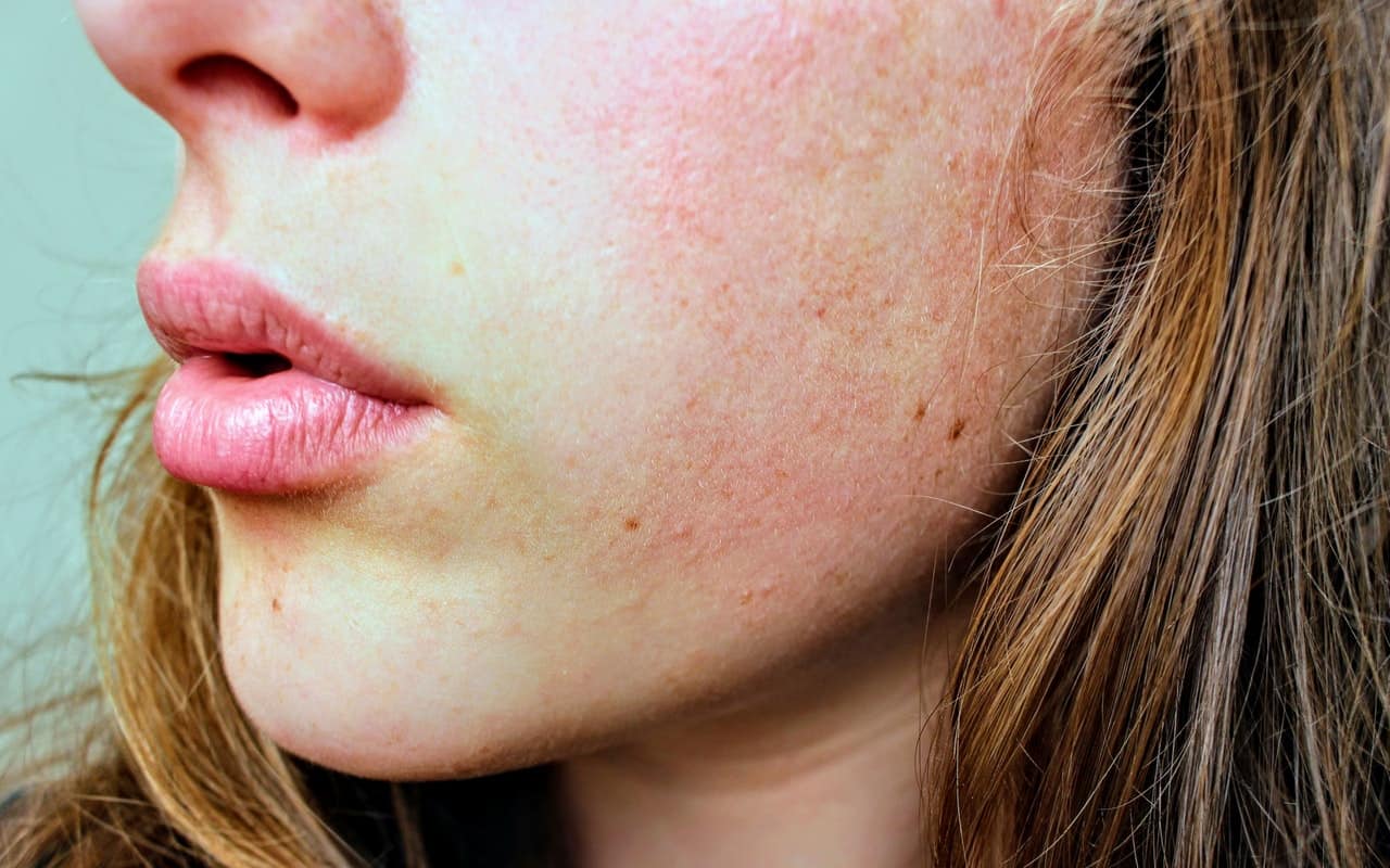 How To Clear Hormonal Acne Fast Complete Guide Thrivenaija