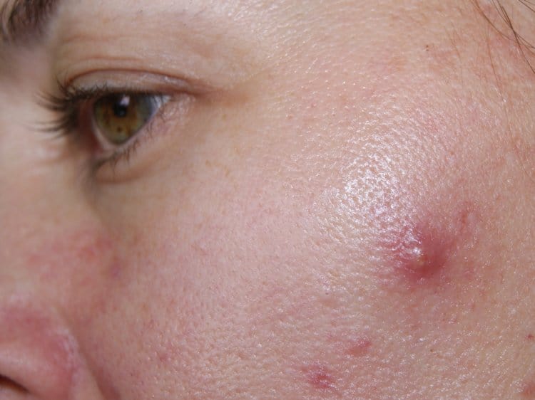 Cystic Acne Causes Treatments 5 Cystic Acne Home Remedies ThriveNaija Cystic Acne Causes Treatments 5 Cystic Acne Home Remedies ThriveNaija